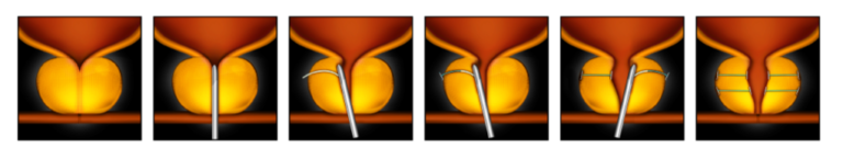 UroLift System – Down East Community Hospital